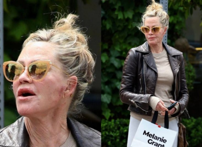 Fresh scars and ulcers on the face: how 65-year-old adorable actress ...