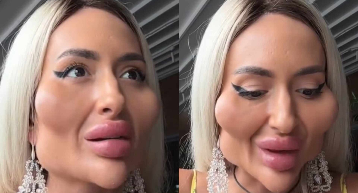 A Woman With The Largest Cheekbones: What Did She Look Like Before The ...